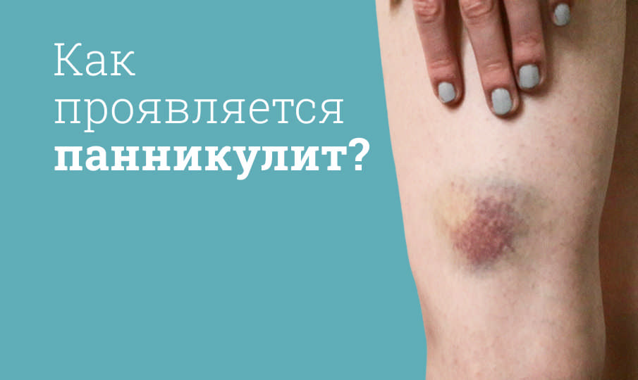 Что такое панникулит простыми словами: Причины, симптомы, диагностика ...